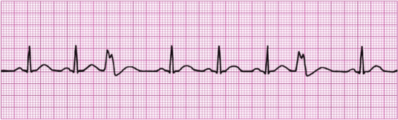 Demystifying ventricular arrhythmias