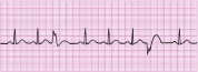 Demystifying ventricular arrhythmias