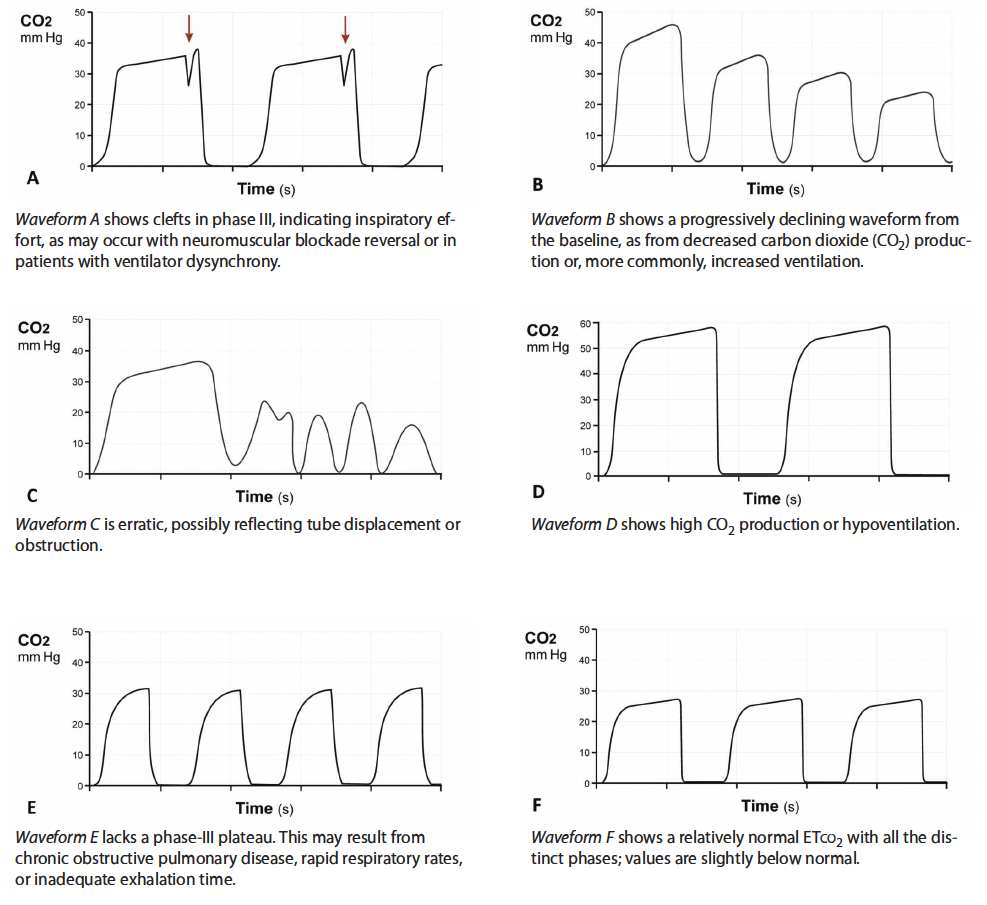 Understanding end-tidal CO2 monitoring