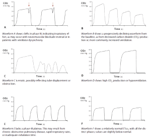 Understanding end-tidal CO2 monitoring
