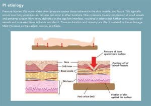 Take action to solve causes of pressure injuries