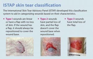 STAMP out skin tears: Skin tear assessment, management, and prevention