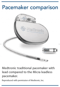 Leadless pacemakers: A new technology in cardiac pacing - American Nurse