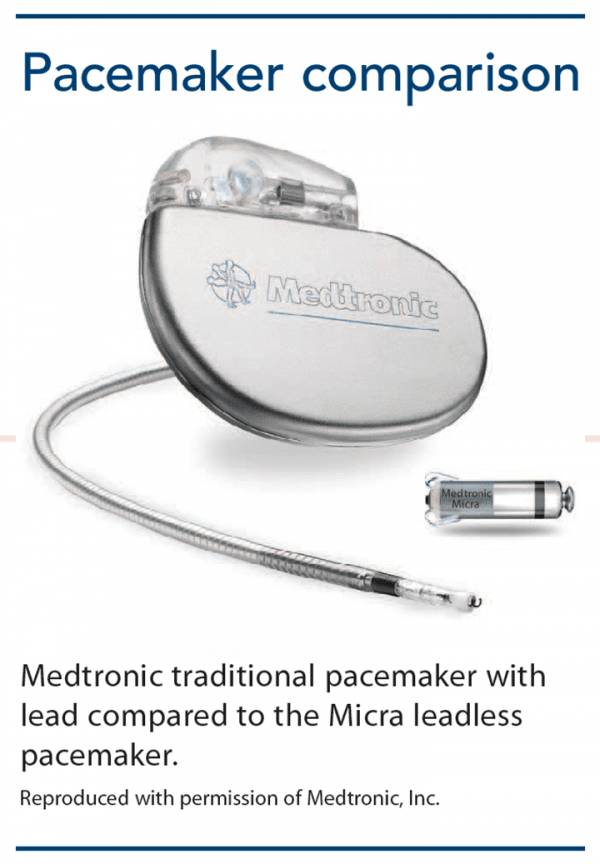 Leadless pacemakers: A new technology in cardiac pacing - American Nurse