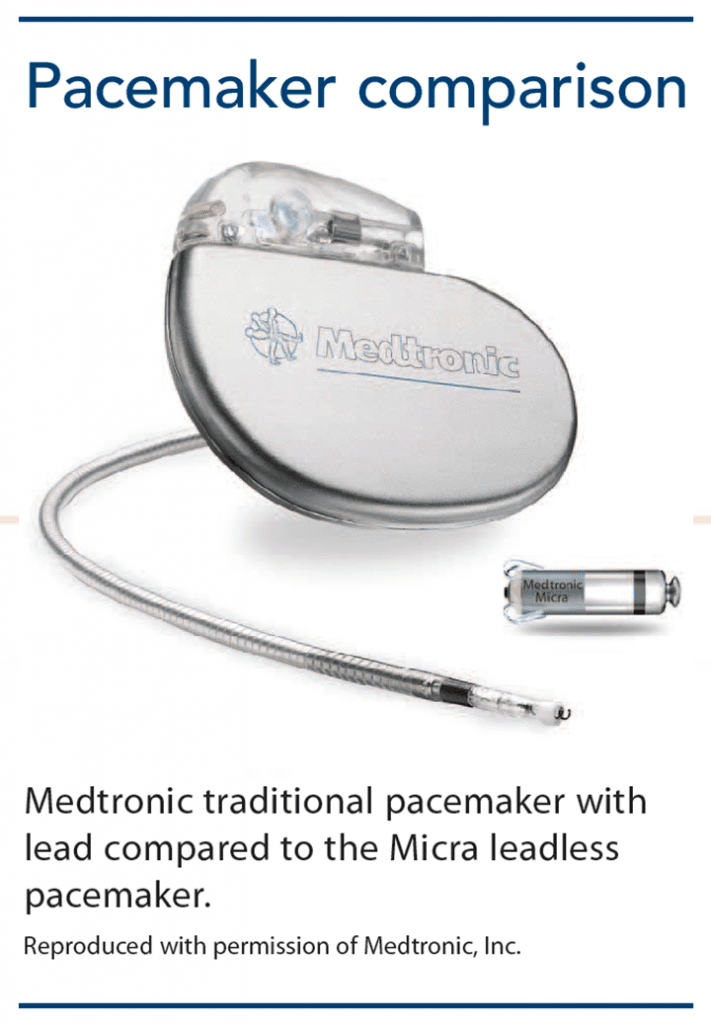 Leadless pacemakers: A new technology in cardiac pacing - American Nurse