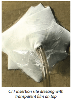 Evidence-based update on chest tube management
