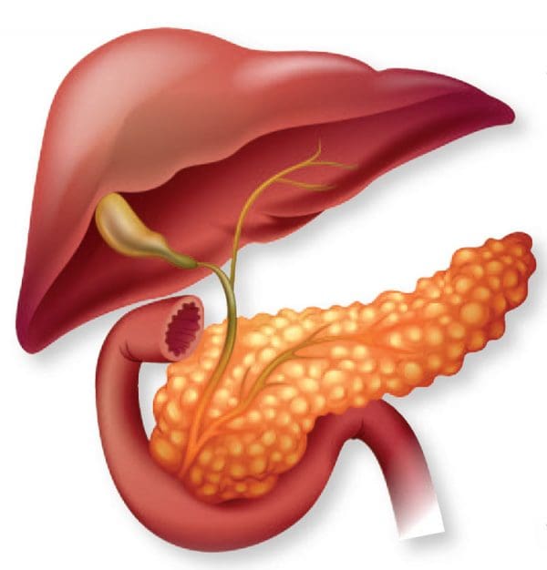 Total pancreatectomy with islet cell autologous transplantation: A ...