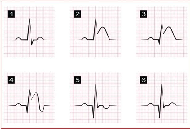 A team approach to STEMI treatment protocols