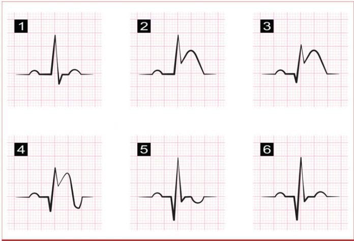 A team approach to STEMI treatment protocols