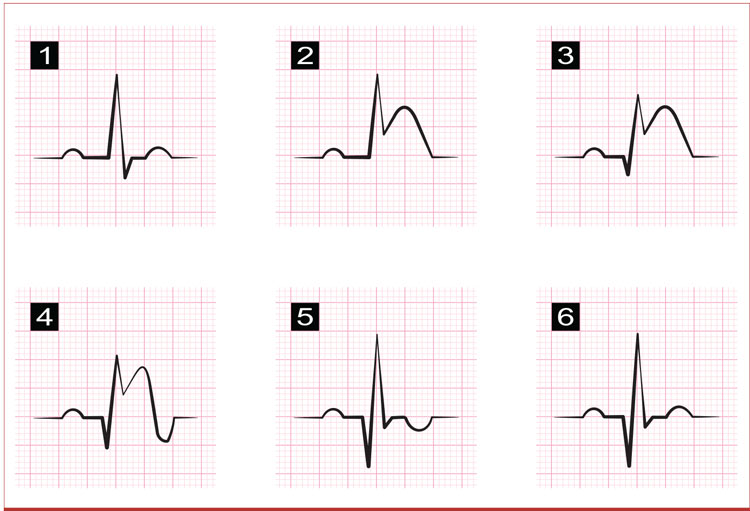 A team approach to STEMI treatment protocols