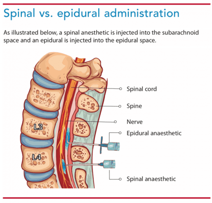An overview of neuraxial anesthesia
