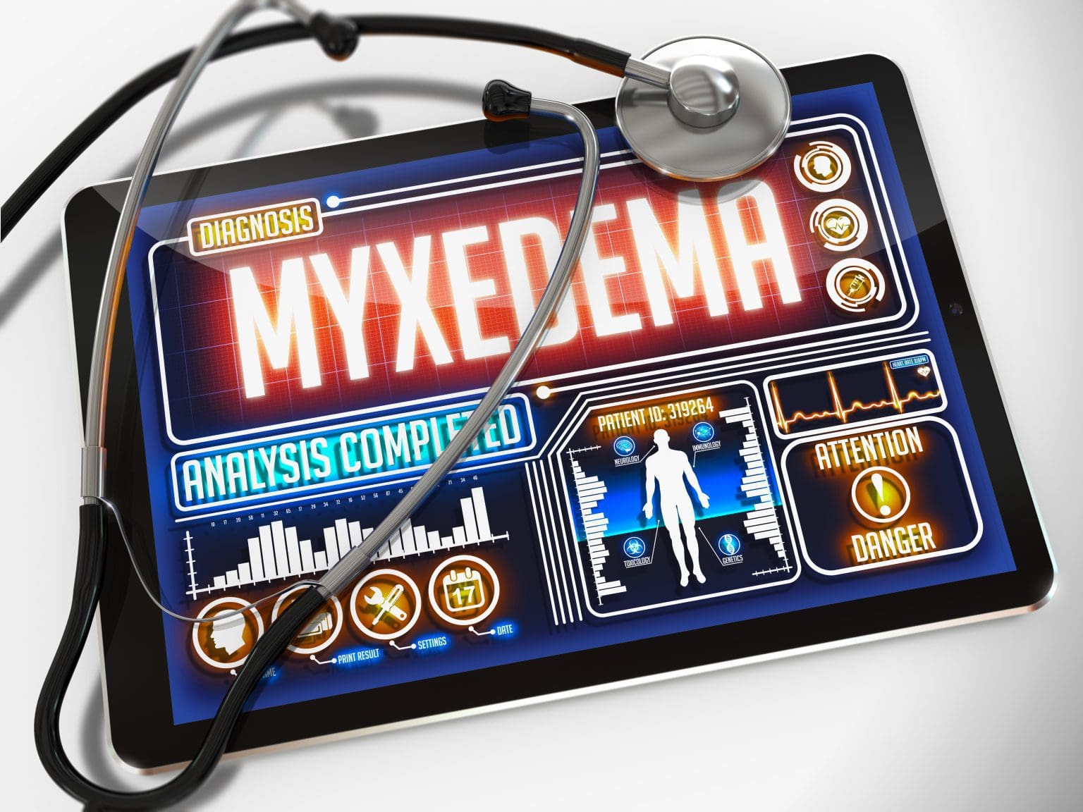 Myxedema coma - more on the most severe type of hypothyroidism