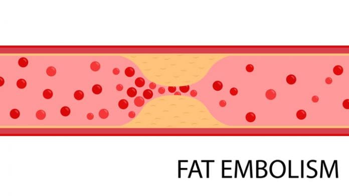 FES (fat embolism syndrome): early identification is critical