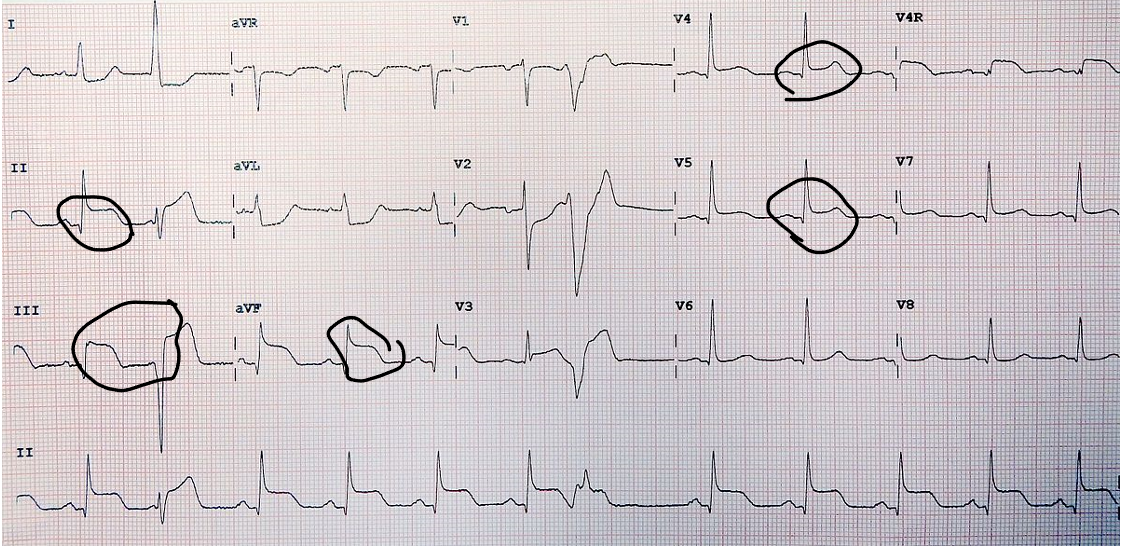 Myocardial infarction: nursing assessment and care