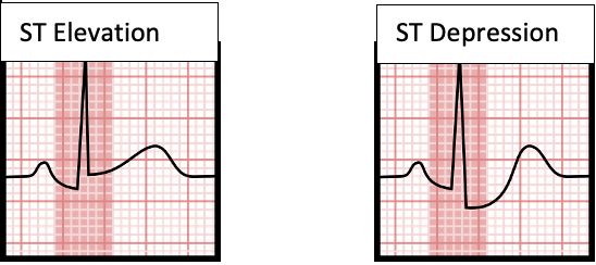Myocardial infarction: nursing assessment and care