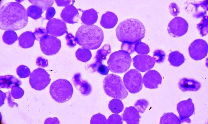 AML differentiation syndrome: emerging oncologic complication