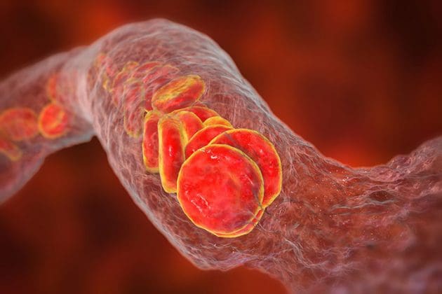 Vasospasm: prompt recognition of subtle signs saves patients' lives
