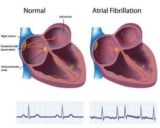 Atrial fibrillation: recognition and management for quality of life