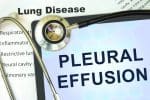 Pleural effusion and early identification