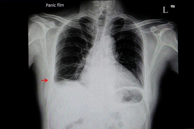 Hemothorax