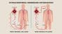 ECMO and nurse-led mobilization
