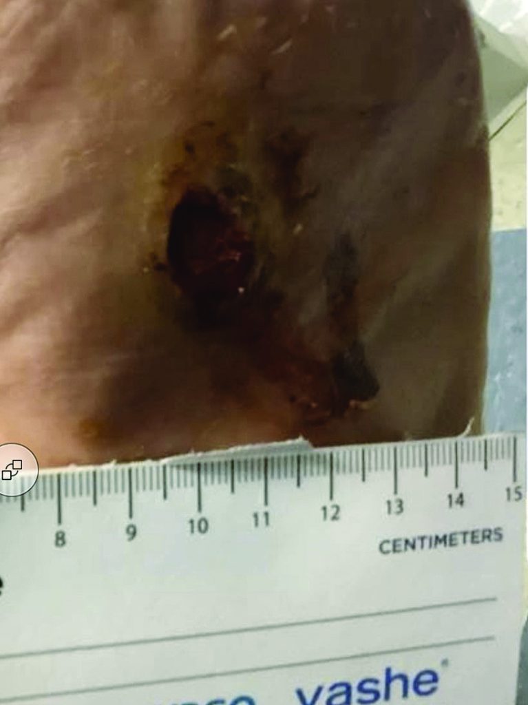 Diabetic foot ulcers in ambulatory settings