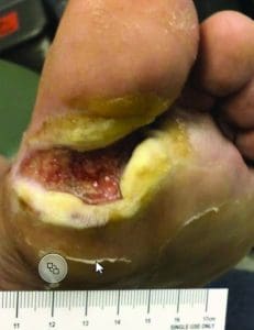 Diabetic foot ulcers in ambulatory settings
