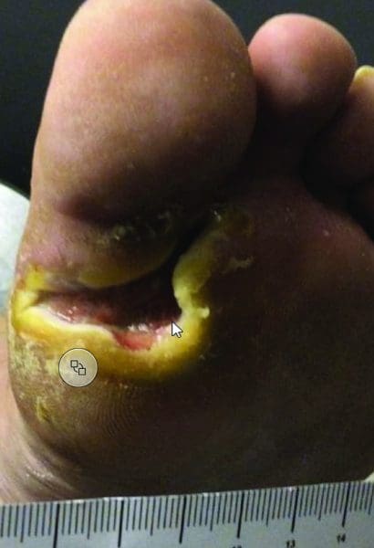 Diabetic foot ulcers in ambulatory settings