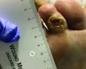 Diabetic foot ulcers in ambulatory settings