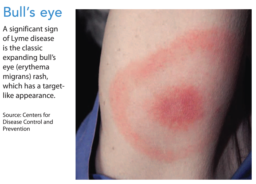 Lyme carditis: A clinical case report
