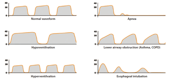 End-tidal CO2 monitoring