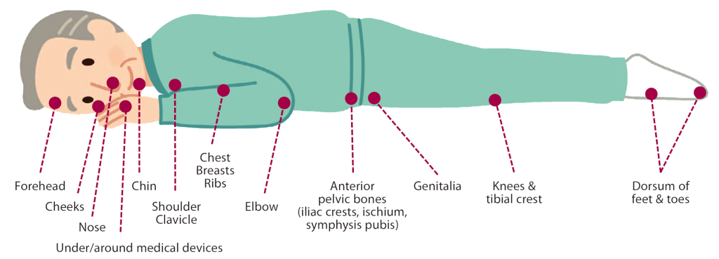 ARDS and prone positioning