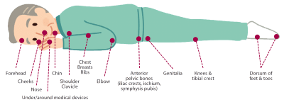 ARDS and prone positioning