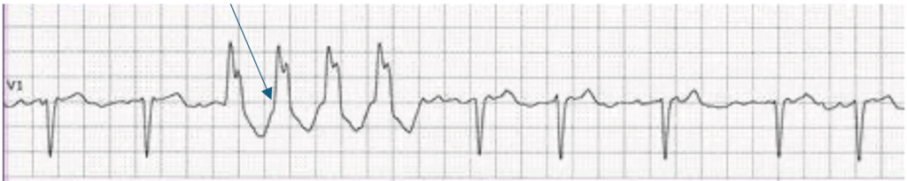 Premature ventricular complexes