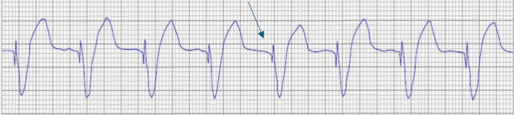 Premature ventricular complexes